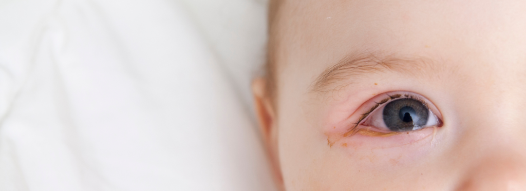 Understanding Pink Eye (Conjunctivitis) - Excel Urgent Care